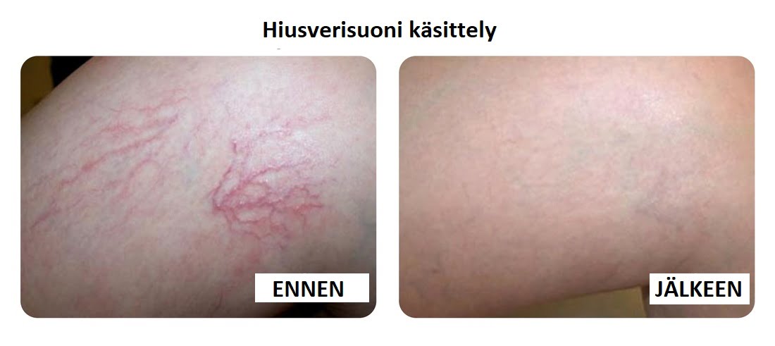 Pintasuonien poisto sekä pigmenttihoito - Kosmetologinatali
